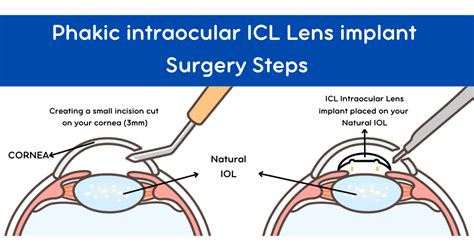 Phakic Lens Surgery Intraocular Icl Akıllı Lazer Göz Merkezi