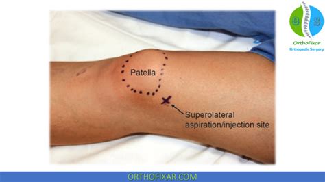 Knee Injection Technique Knee Injection Model