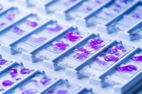 Tissue Microarrays Cancer Controls