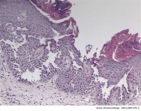 Papular Acantholytic Dermatosis In The Genito Crural Region A Localized Form Of Darier Disease