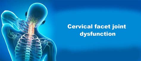 Neck Facet Syndrome Symptoms