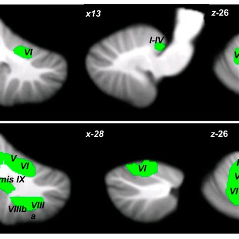 Voxel Wise Anova On Cerebellar Gm Density Cerebellar Regions Showing