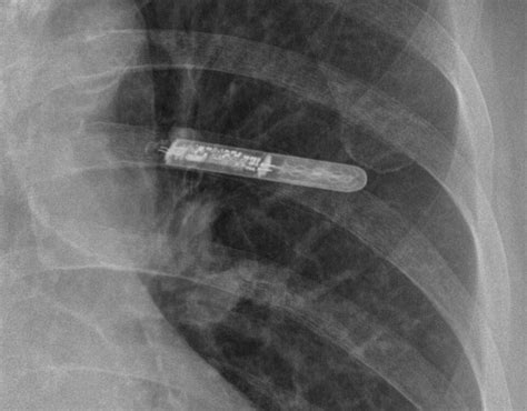 Loop Recorder Specialist Cardiology Loop Recorder Specialist Cardiology