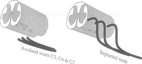 Schematic Illustration Of The Method Of Ventral Root Avulsion And
