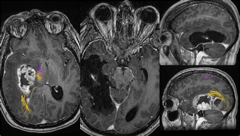 Stealth Tractography Ian Suszko