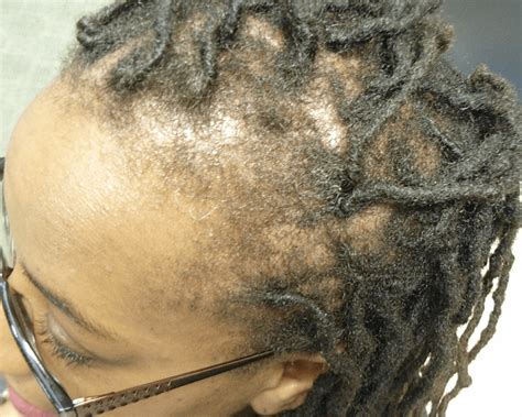 Black Hair Loss Before After Treatment Photos The Hair Loss Centre