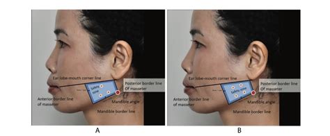 Tmj Botox In North York For Lasting Relief — Forest Manor Dental