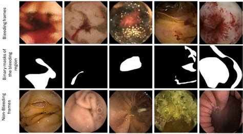 논문 리뷰 Wcebleedgen A Wireless Capsule Endoscopy Dataset And Its