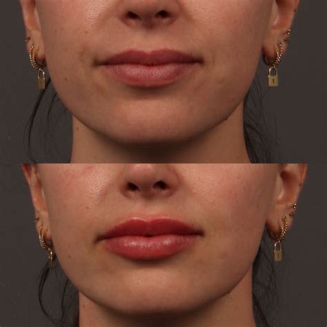 Lip Filler Cheek Filler Botox Brow Lift 7 Before And After Photos In Phoenix And Scottsdale Arizona