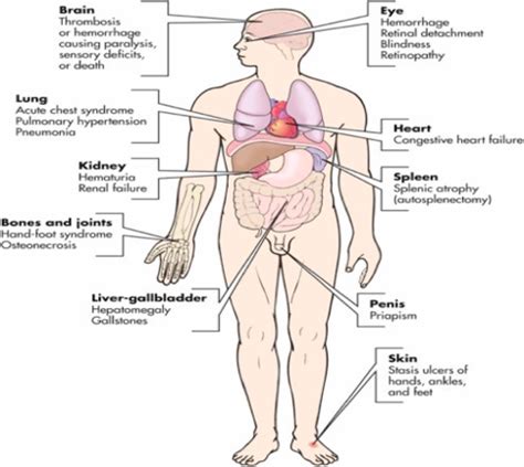 Hematologic Disorders Flashcards Quizlet
