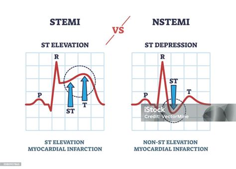 Stemi Vs Nstem Heart Beat Impulse In Cardio Visualization Outline