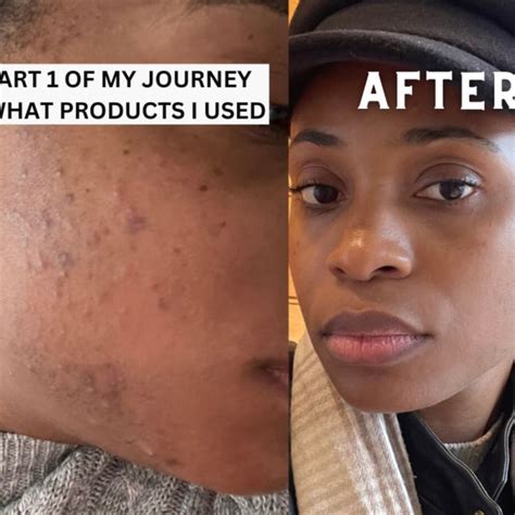 How To Get Rid Of Hyperpigmentation Artofit