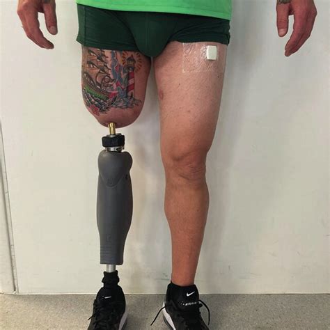 Patient With A Transfemoral Amputation Of The Right Lower Limb And The