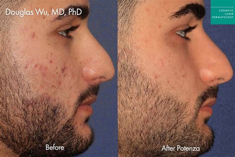 Acne Scars Forehead Before And After
