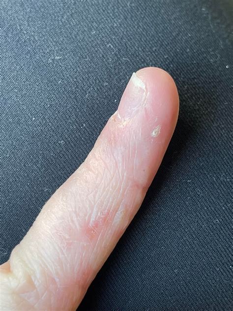 Finally Healed 8 Month Long Flare Heres What I Did Am Still Doing R Dyshidrosis