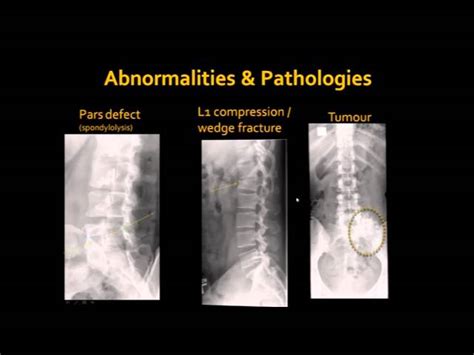 Understanding Common Vertebral Column Abnormalities In Radiology Galaxy Ai Galaxy Ai