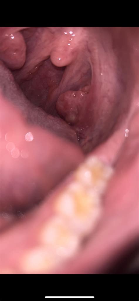 Tonsil Stone Cyst R Tonsilstones