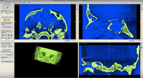 Three Dimensional Quantification Of Mandibular Asymmetries In Caucasian Adult Patients With