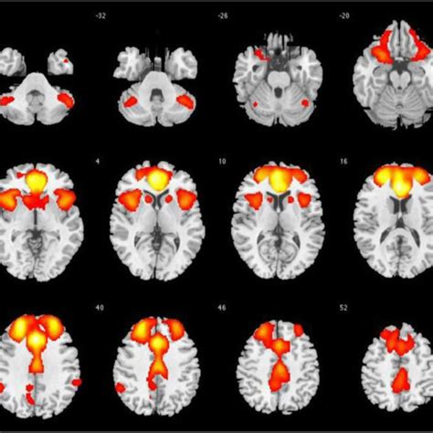 Abnormal Functional Connectivity Of Salience Network Rois In The Fes