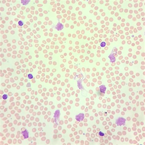 Lymphocytes Normal And Atypical