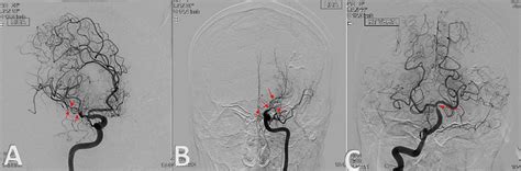 A Oblique View Right Ica Angiogram Demonstrating Normal Anterograde