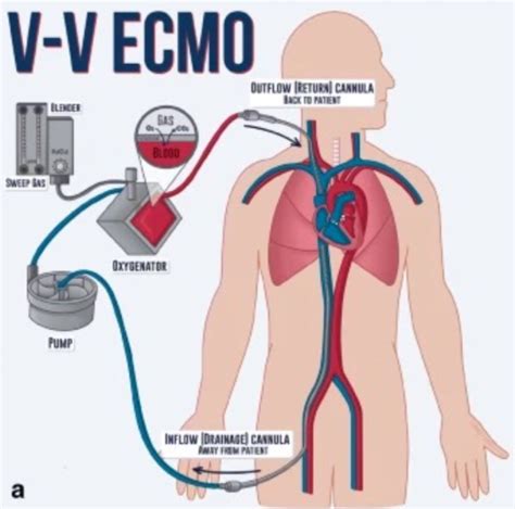 Extra Corporeal Membrane Oxygenation Ecmo Flashcards Quizlet