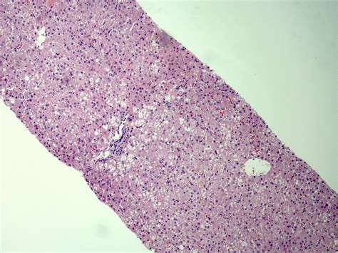 Pathology Outlines Wilson Disease