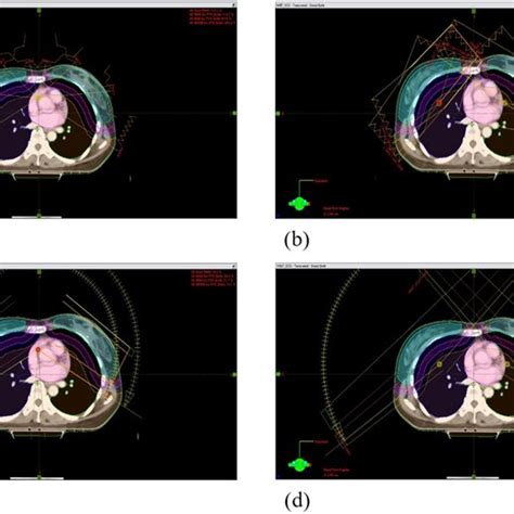Dose Distributions On An Axial View Of A Imrtiso1 B Imrtiso2