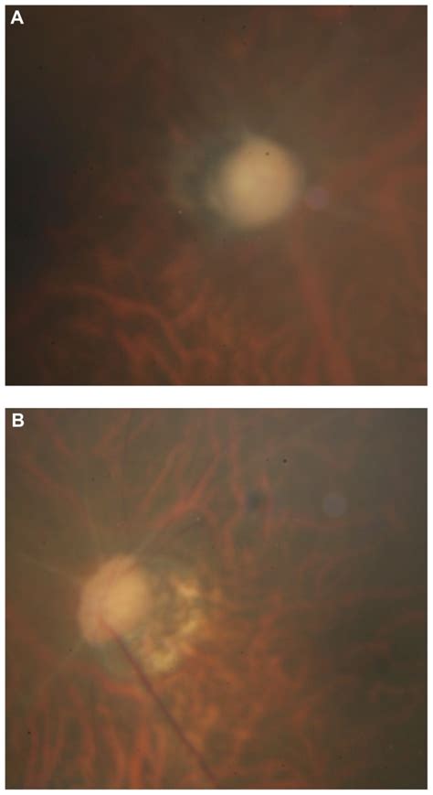 Optic Disc Appearance About Months After Radiofrequency Radiation Download Scientific Diagram