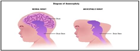 Anencephaly Diagram