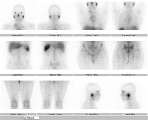 Radiopaedia Case Lambda Sign Of Sarcoidosis Id 76777 Study 88616 Nc