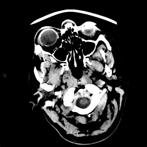 Cerebellar Abscess Radiopaedia 78135 90671 Axial Non Contrast Nc
