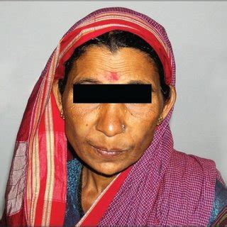 Facial View Showing The Extraoral Diffuse Swelling Download Scientific Diagram