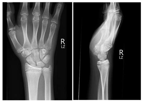Fracture Dislocation Of The Pisiform Bone In 14 Year Old Boy—a Case Report