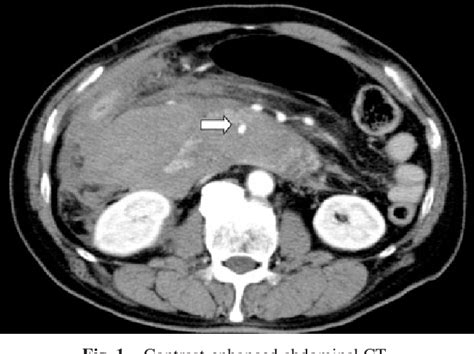 Figure 1 From Sa Case Of Bowel Perforation After Arterial Embolization
