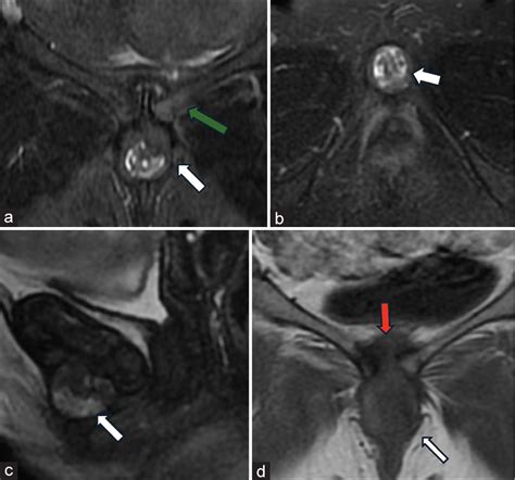 Central Groin Pain A Pictorial Review Indian Journal Of