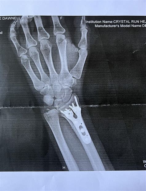 Brokendislocated Left Wrist Rbrokenbones
