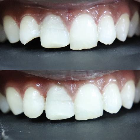 Class Iv Composite Restoration Myzerodonto