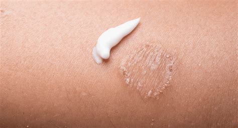 Celulitis Infecciosa De La Piel Y Los Tejidos Blandos