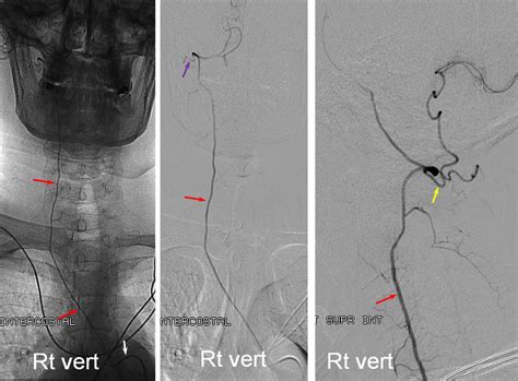 Vertebral Artery Neuroangio Org