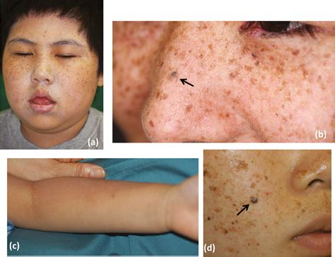 Xeroderma