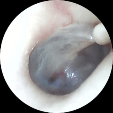Bleeding Behind Eardrum Is This Normal With Etd My Ears Wont Pop R Eustachiantube