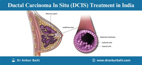 Ductal Carcinoma In Situ Dcis Treatment In India Dr Ankur Bahl