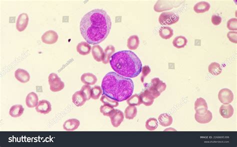 Monoblastic Leukemia