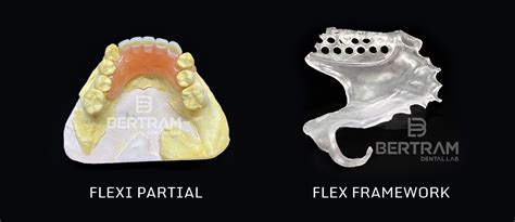 Flex Clasps And Frameworks Bertram Dental Lab