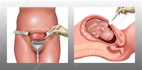 Cesarean Section Incisions Illustration Stock Image C0436070