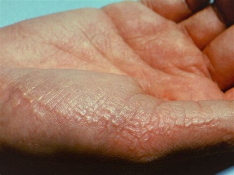 Punctate Keratosis