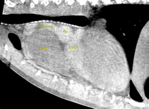 Ct Thymoma With Good Prognosis For Surgical Resection In A 11 Year
