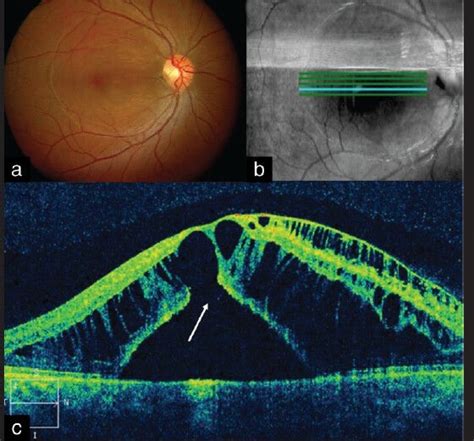 A Color Fundus Image Shows The Macula Of A 24 Year Old Male With