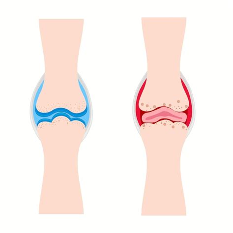 Premium Vector Normal Joint And Rheumatoid Arthritis